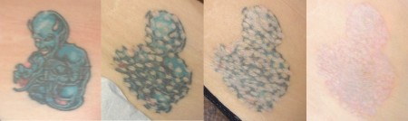 Fjernelse af tatoveringer uden laser - FAZION